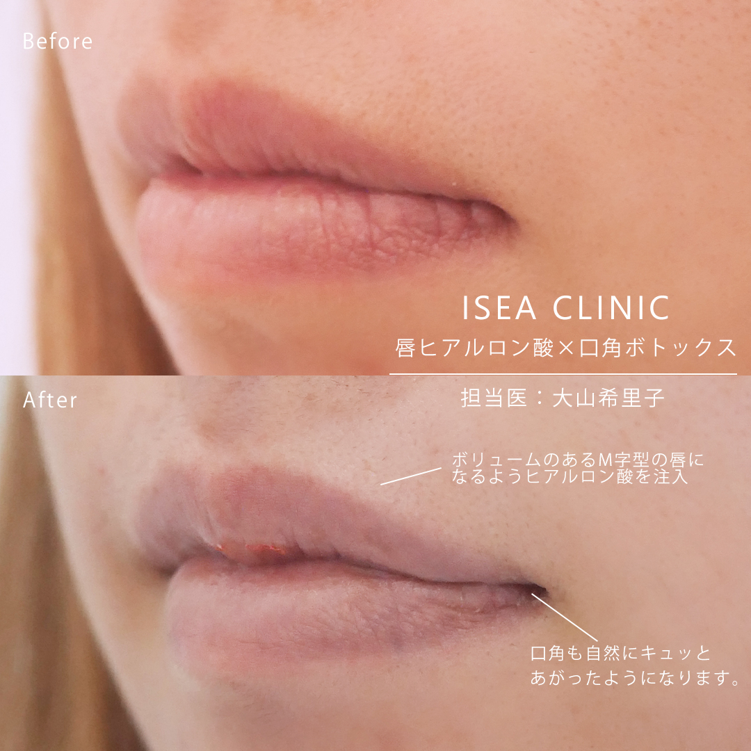 キャンペーンページ｜美容外科・美容皮膚科の東京イセアクリニック(銀座・渋谷)